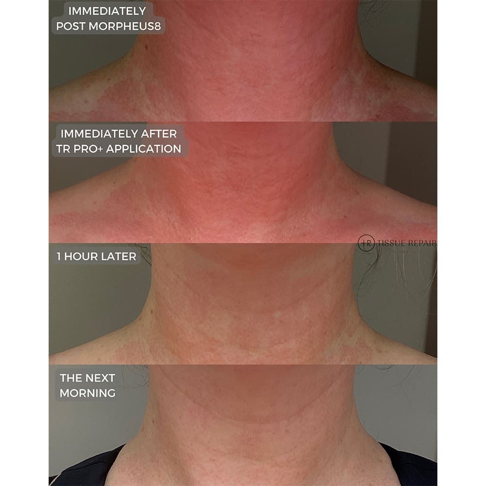TR Pro+™ – The Skin Lab Skincare